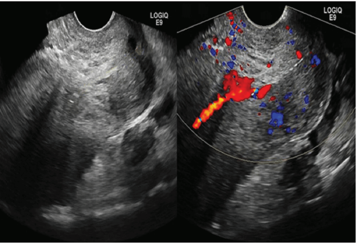 Preliminary Investigation into Ultrasound and MRI Presentation of Large ...